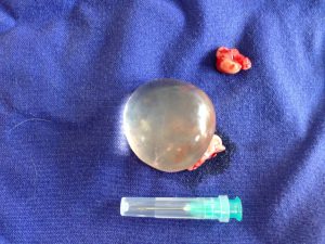 Les Symptômes, diagnostic et traitement du kyste ovarien – VoixVoie de ...